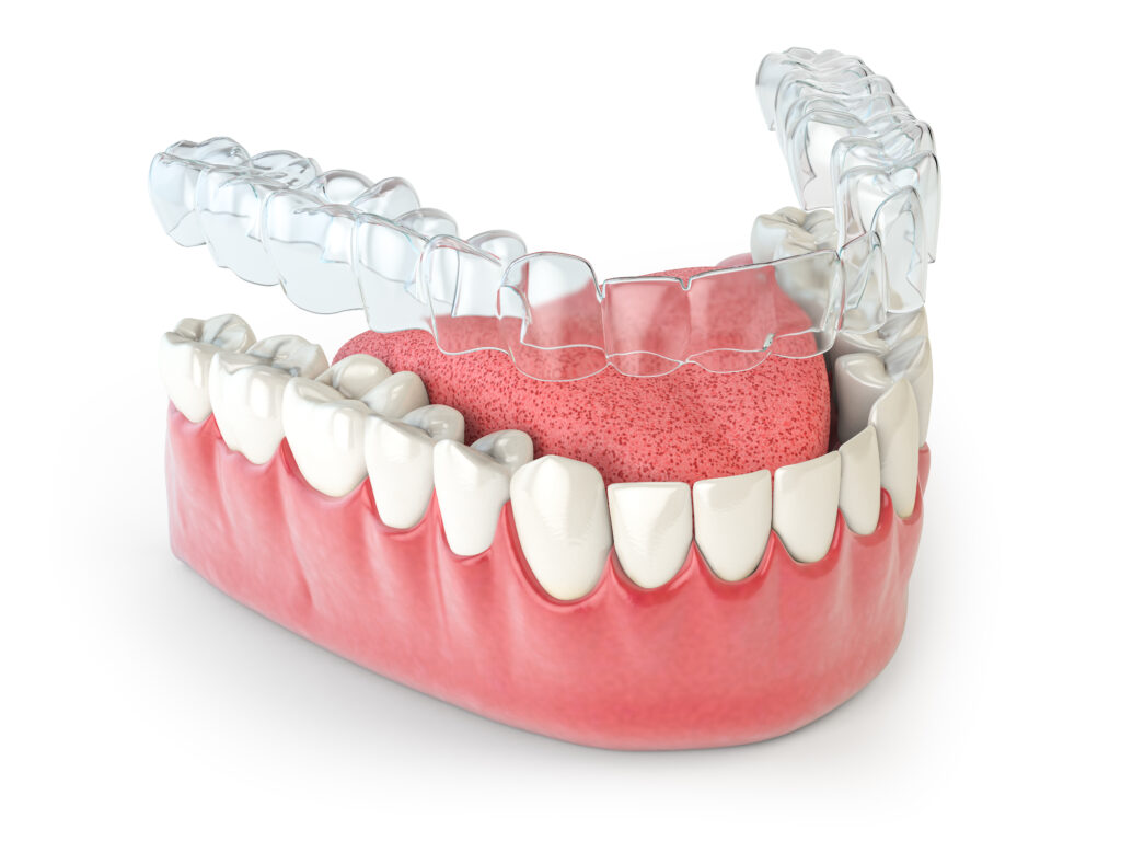 Invisalign Silver Spring, MD | Germantown Invisalign